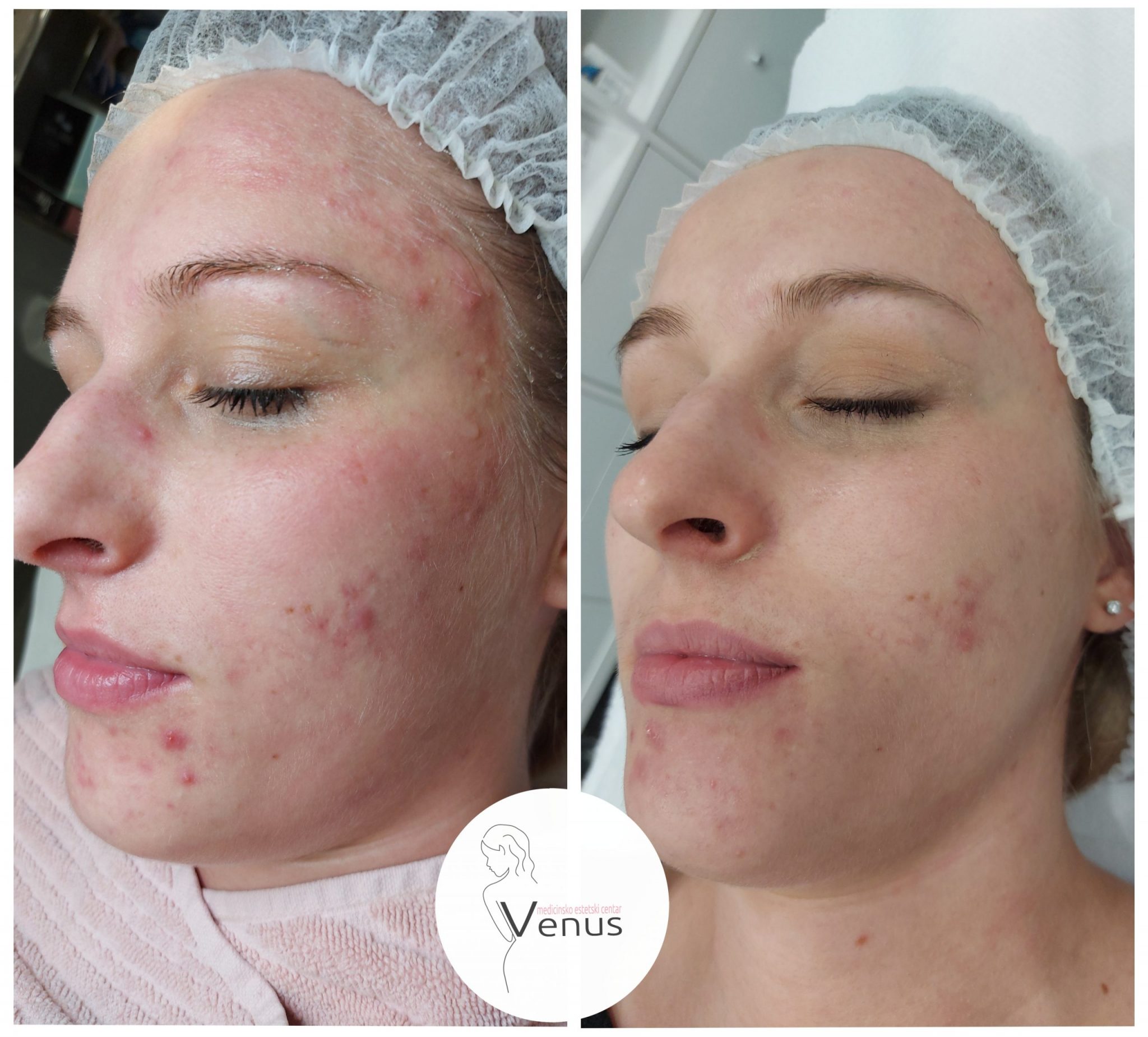 Dermapen – Venus